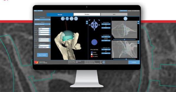 Wright Medical's First Shoulder Procedure with BLUEPRINT Mixed Reality ...