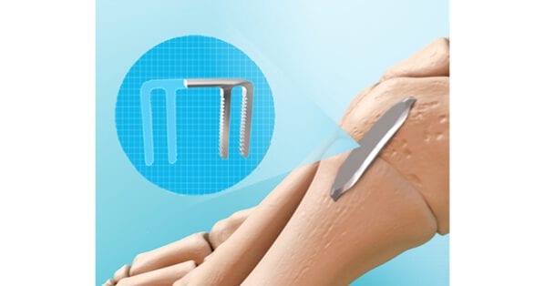 MedShape Launches DynaClip Forte Bone Fixation | ORTHOWORLD