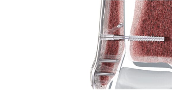 DePuy Synthes Launches FIBULINK Syndesmosis Repair | ORTHOWORLD