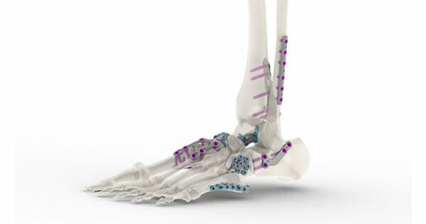 Tyber Medical Gains FDA 510(k) on Foot/Ankle Plates | ORTHOWORLD