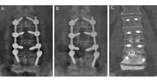 Tyber Medical Launches Study of Titanium Integrated Interbody | ORTHOWORLD