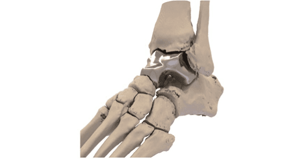 FDA Approves Additive Ortho's Talus Spacer | ORTHOWORLD