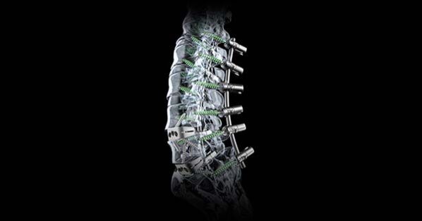Biedermann Motech Expands MOSS VRS Pedicle Screw Technology | ORTHOWORLD