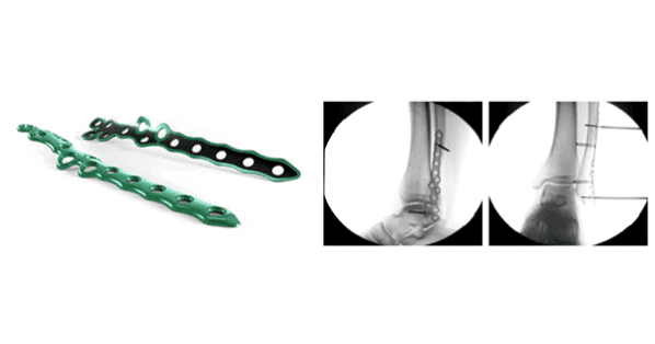 Carbon22 Gains FDA 510(k) for Apollo Ankle Plates | ORTHOWORLD