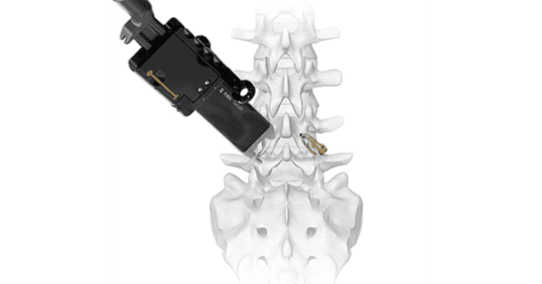 First Commercial Cases with Spinal Elements Karma MIS System | ORTHOWORLD