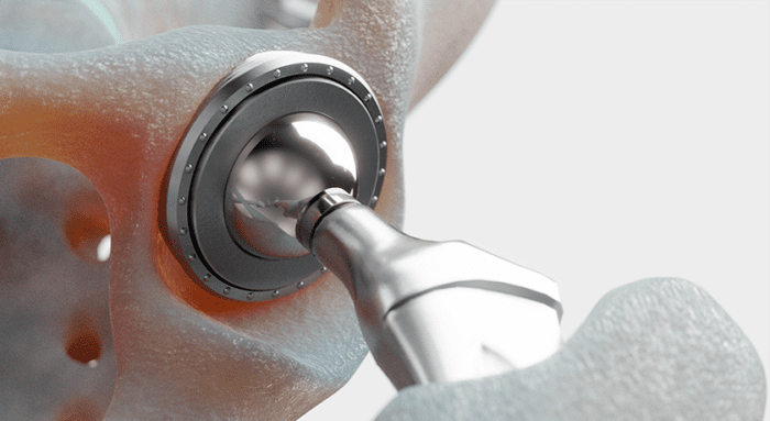 New Total Knee and Hip Products Focus on Additive, Materials, Robotics ...