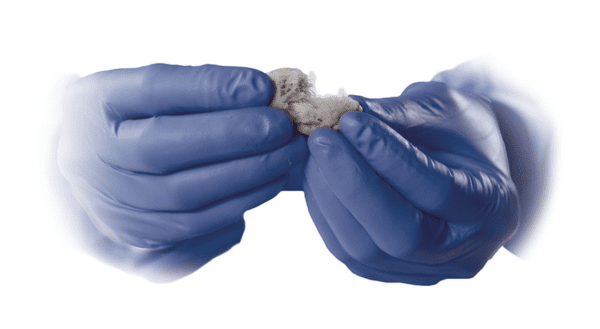 First Patient Implants with Orthofix Legacy Demineralized Bone Matrix