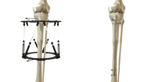 Expanded Indications for Precice Limb Lengthening