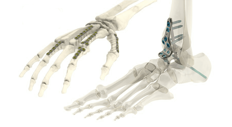 Tyber Medical Expands Anatomical Plate Portfolio