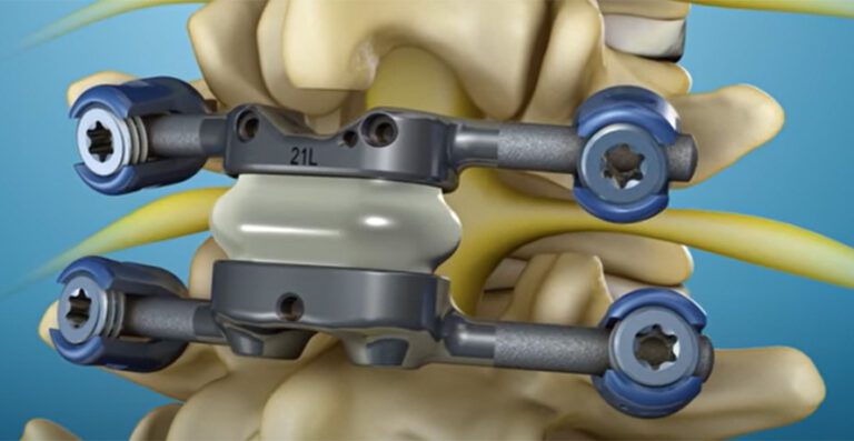 Premia Spine TOPS System Achieves FDA Premarket Approval with ...