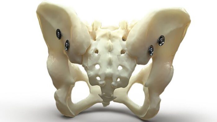 FDA 510(k) Clearance for Bone Bolt Fracture Repair System | ORTHOWORLD FDA 510(k) Clearance for Bone Bolt Fracture Repair System | ORTHOWORLD