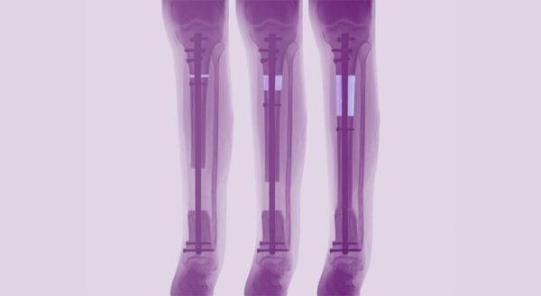 Globus Medical Launches Precice Bone Transport Ex-US | ORTHOWORLD