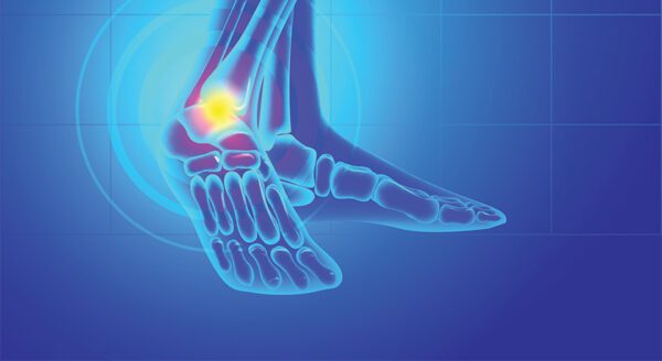 NovaBone Debuts New Bioactive Glass Syringe for Foot & Ankle | ORTHOWORLD
