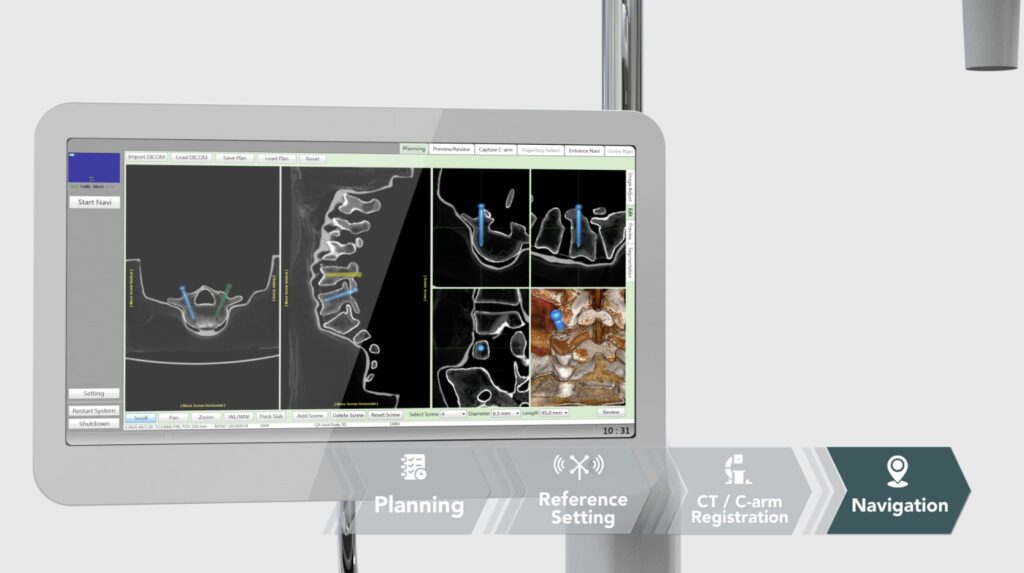 Captiva Spine's First ASC Navigated MIS Lumbar Fusion Series | ORTHOWORLD