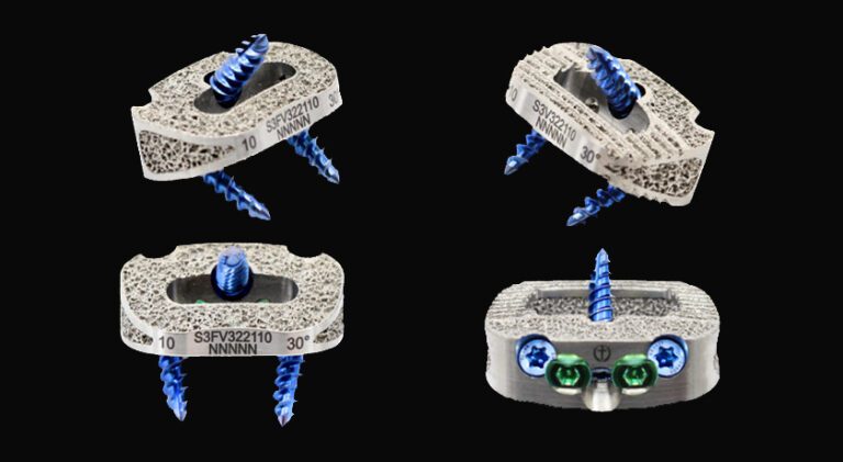 Eminent Spine Clinical Study Update: ALIF Standalone System