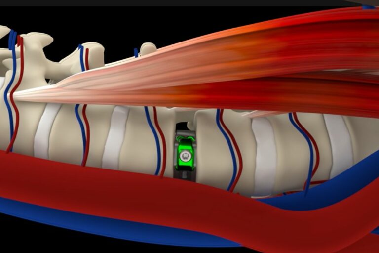 First Use of OneLIF Cage with Laterally-Positioned Patient | ORTHOWORLD