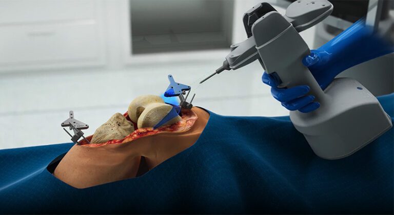 THINK Surgical Announces TMINI Procedure Milestone | ORTHOWORLD