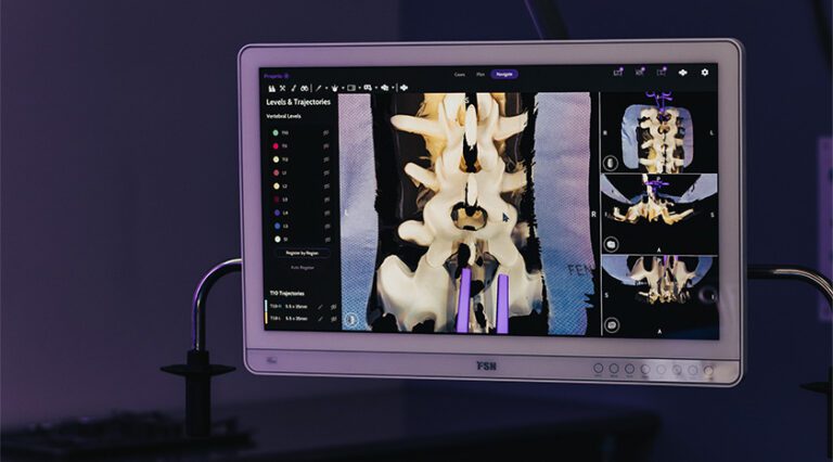 Proprio Completes 50 Surgeries with First AI-Powered Surgical Platform ...