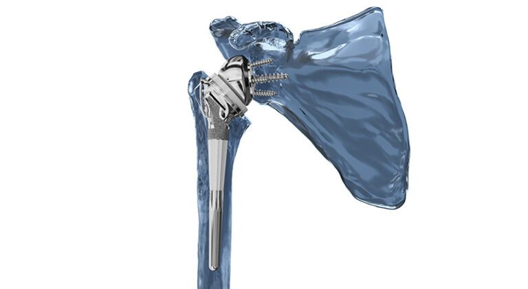 Catalyst OrthoScience Gains 510(k) for Shoulder Fracture System ...