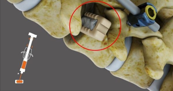 Abyrx Gains Additional Fda Clearances For Montage Bone Putty