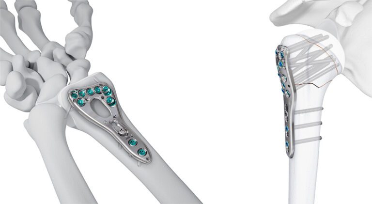 J&J Medtech Launches VOLT Wrist and Proximal Humerus Plating