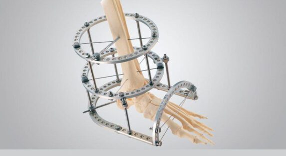 Orthofix Launches the TrueLok Elevate Transverse Bone Transport System ...