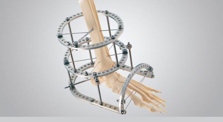 Orthofix Launches the TrueLok Elevate Transverse Bone Transport System ...