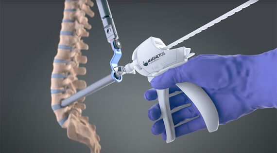 Kuros Biosciences Launches the MagnetOs MIS Delivery System | ORTHOWORLD
