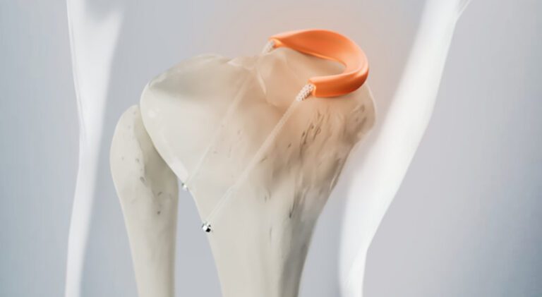 Smith+Nephew Introduces AETOS Shoulder | ORTHOWORLD