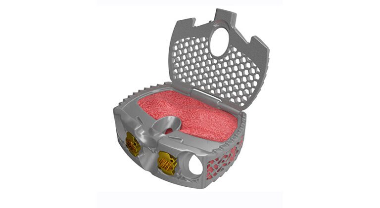 Spinal Elements Launches Ventana A ALIF System | ORTHOWORLD