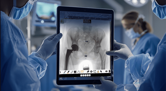 Smith+Nephew Introduces AETOS Shoulder | ORTHOWORLD